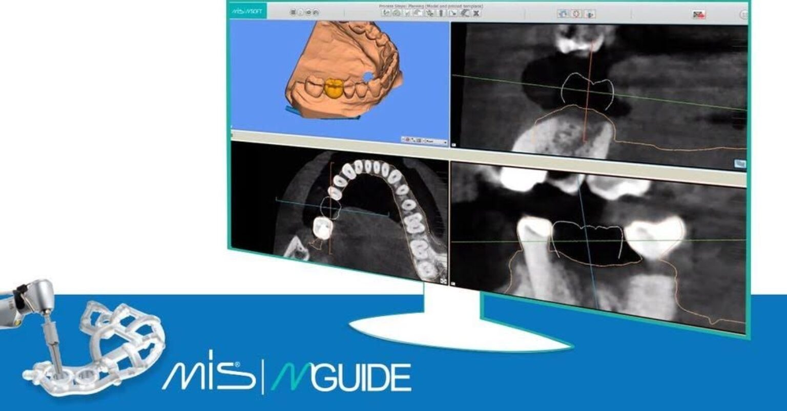 MGuide – Σύστημα κατευθυνόμενης τοποθέτησης εμφυτευμάτων της MIS ...