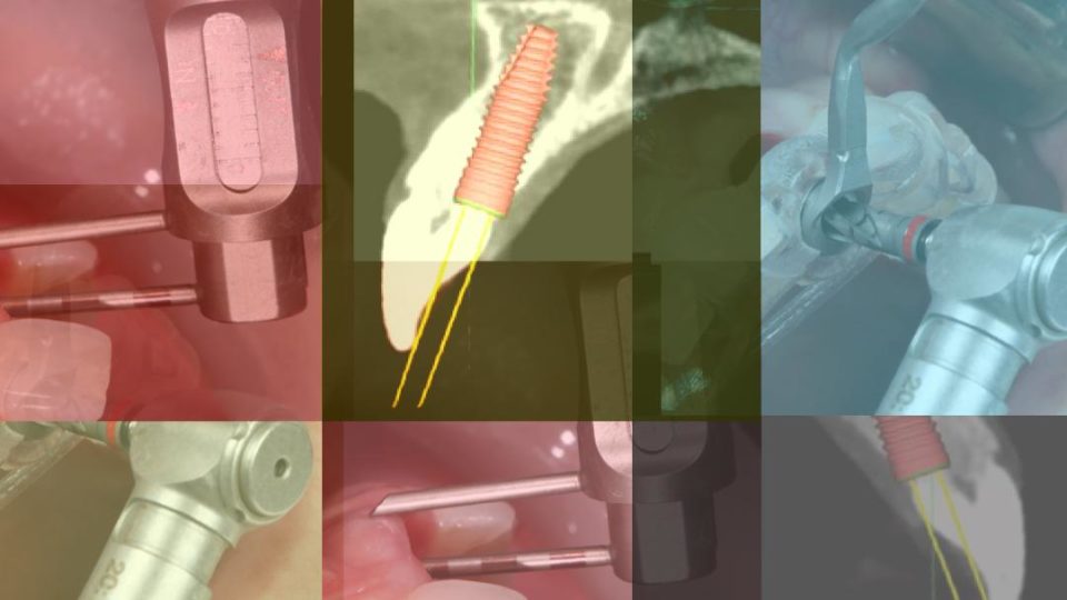 Seminars (Archive) 7/10/2018 - New Surgical Technique IMMEDIATE ...